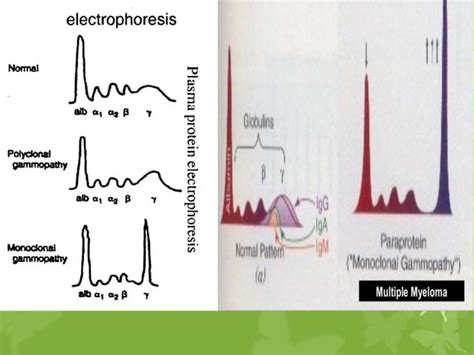 Multiple Myeloma Case Presentation Pptx
