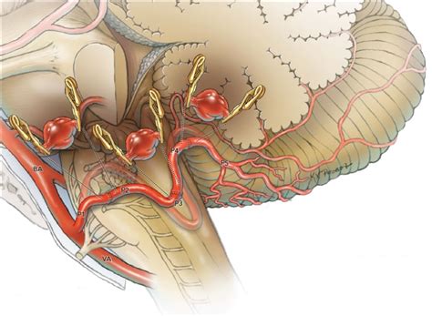 Reanastomosis Neupsy Key
