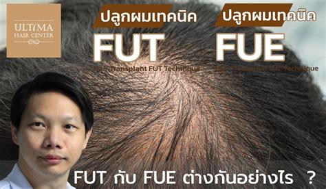Fut กับ Fue ต่างกันอย่างไร Ultima Hair Center
