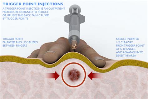 Trigger Point Injection Therapy Associated Pain Specialist