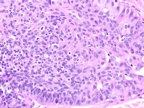 Pathology Outlines Usual Ductal Hyperplasia