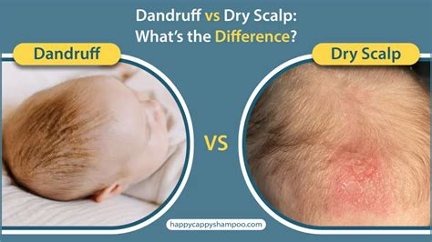 Dandruff Vs Dry Scalp Whats The Difference
