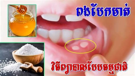 វិធីព្យាបាលងាយៗ ពងបែកក្នុងមាត់ គឺជាដំបៅដែលជាធម្មតា លេ ចឡើ ងលើអ ញ្ចា ញ ធ្មេញ អណ្ដាត និងកៀនបបូ រ