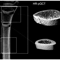 Regions Of Interest At The Left Distal Tibia By DXA Left And The Volumes Of Interest As D