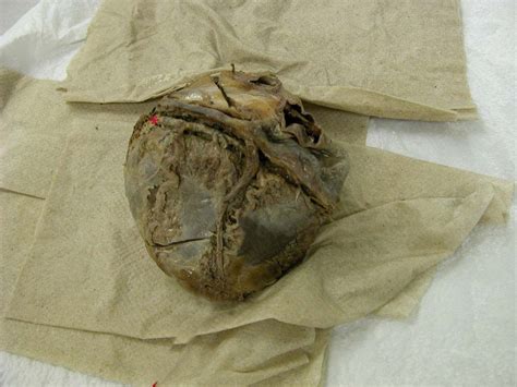 Interventricular Sulcus And Septum