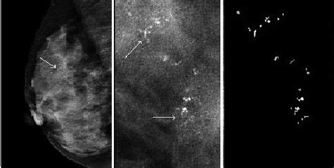Microcalcification Classification Kaggle