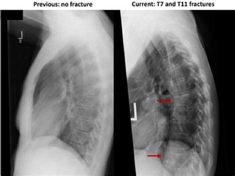 Thoracic Spine X Rays 13 Years Prior To And Immediately Following