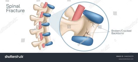 Backbone Spinal Cord Compression Fracture Vertebra Stock Vector