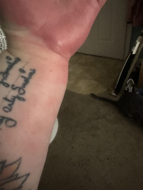 Sepsis And Cellulitis Returns Rpopping