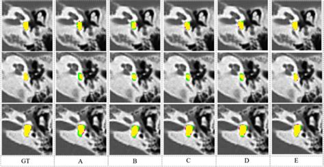 Visualized Segmentation Results Of Ablation Experiments The First Download Scientific Diagram