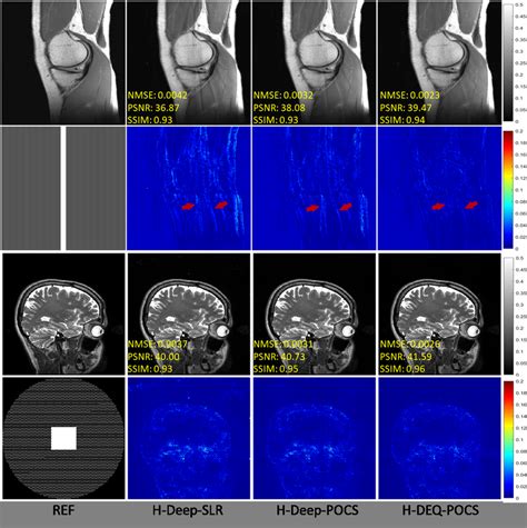 Reconstruction Results Under 1 D Regular Undersampling At R 3 On Knee