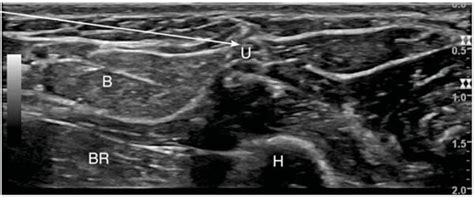 Ulnar Nerve Injection Wikism Sports Medicine Wiki