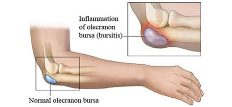 Bursitis Del Codo Causas Y Tratamientos De Fisioterapia
