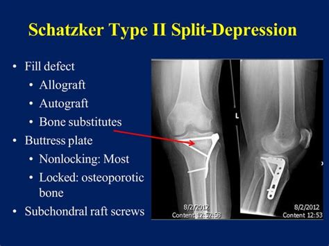 Proximal Tibia Fractures And Its Management Pptx
