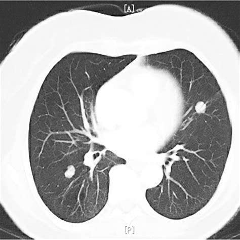 A Computerized Tomography Chest Scan Showing Multiple Bilateral
