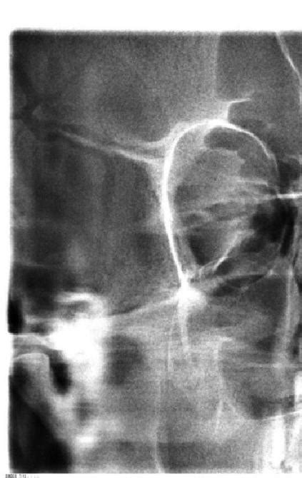 Sinus View Showing Opacification Of Right Maxillary Sinus Download