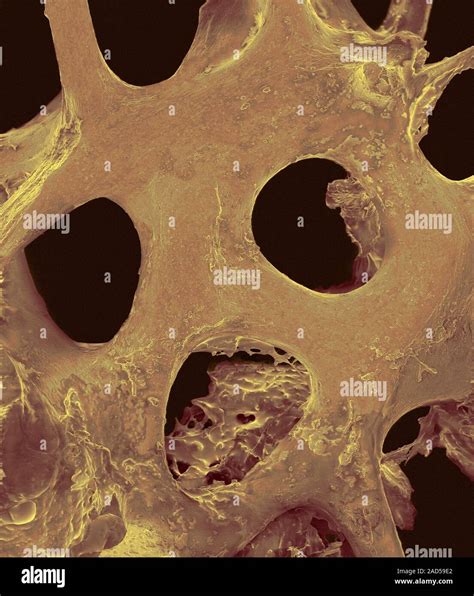 Cancellous Spongy Bone Tissue Coloured Scanning Electron Micrograph Sem Bone Tissue Is