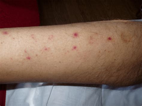 Ecchymosis Causes Symptoms And Treatment