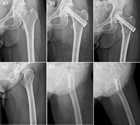 Radiographs Of An 78 Year Old Female Patient With Non Displaced Femoral Download Scientific