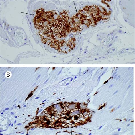 S Expression In The Myenteric Plexus Of A Control A And A Patient Download Scientific