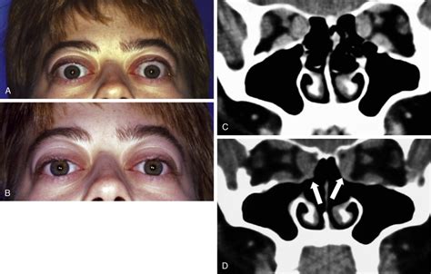 Endoscopic Orbital Decompression Ento Key