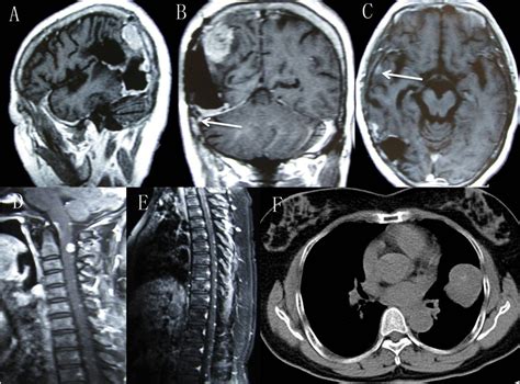 Anaplastic Meningioma Pacs