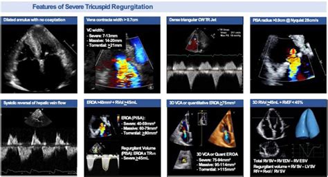 Key Echocardiographic Considerations For Tricuspid Valve Transcatheter