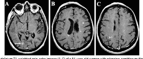 Figure 6 From Mri In Multiple Sclerosis Whats Inside The Toolbox Semantic Scholar