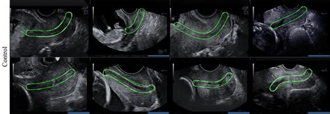 Results Of Cervical Segmentation On Transvaginal Ultrasound Images