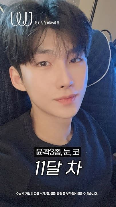 남자 윤곽3종 눈 코 성형 후기 Shorts Youtube