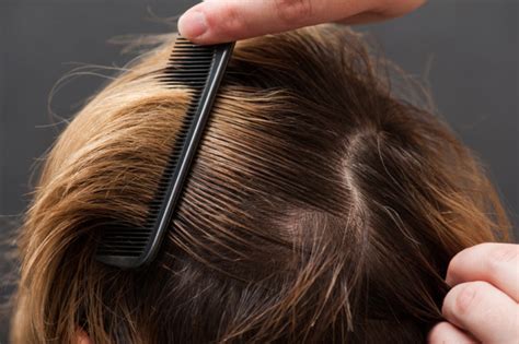 Excess Sebum On Scalp Causes Effects And How To Control It Bright Fashion Magazine