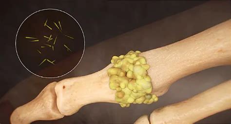 Gout Causes Symptoms And Treatments