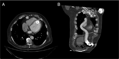 Non Obstructive Left Ventricular Assist Device Outflow Thrombus What