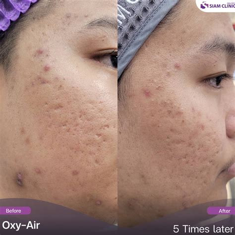 Acne Treatment Before And After Photos Siam Clinic Thailand