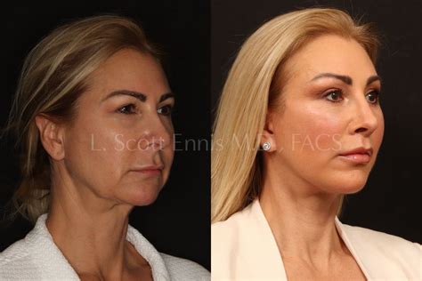 Vertical Deep Plane Facelift Before And After Photos By Dr Ennis
