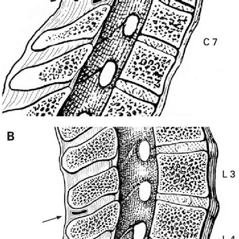 Pdf Cervical Interspinous Bursitis In Active Polymyalgia Rheumatica
