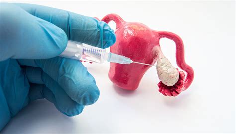 Ovulation Induction Bloom Fertility Clinic