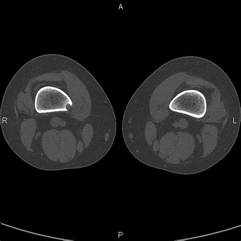 Fibrome Non Ossifiant Pinkybone
