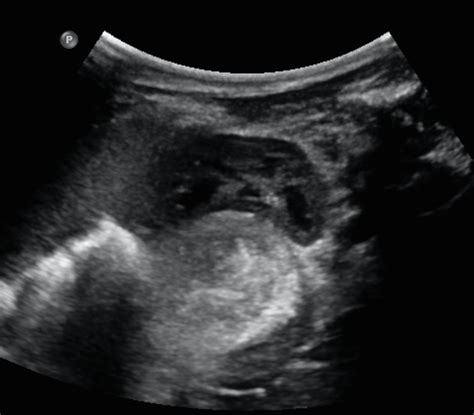 Neuroblastoma Ultrasound