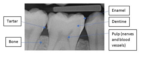 Dental X Rays A Peek Inside Your Teeth New Street Dental Care