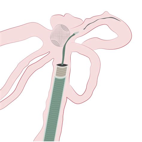 Solitaire Platinum Revascularization Device