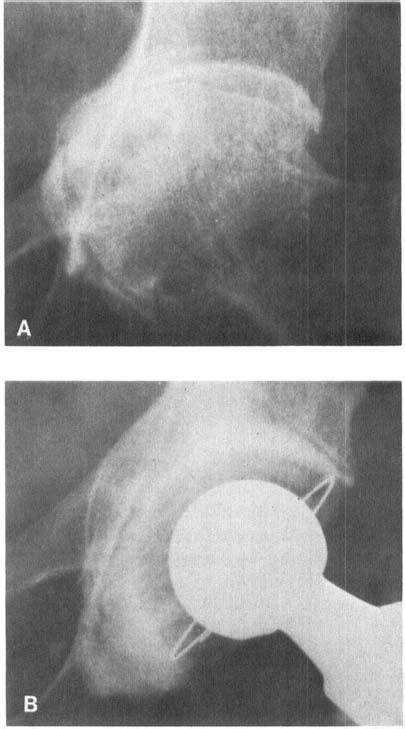 A Before The Operation Idiopathic Acetabular Protrusion B 19 Months