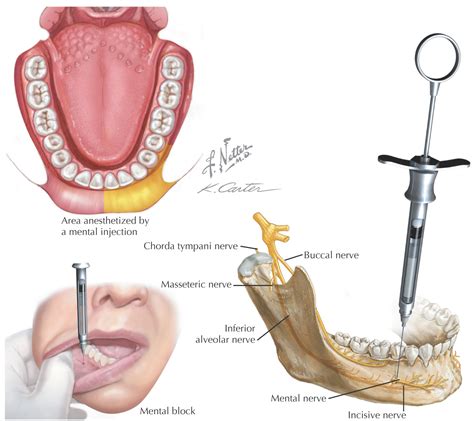 Dental Mental Nerve Block At Bernice Guarino Blog