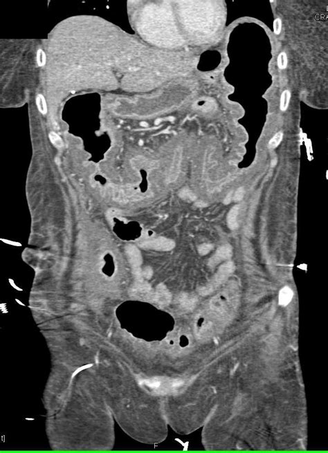 Pseudomembranous Colitis Pmc Colon Radiology Case Studies Ctisus