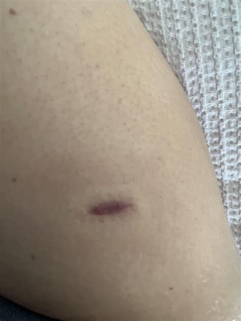 How Would You Heal This Scar Surgery Gone Wrong 11 Weeks Ago And Am