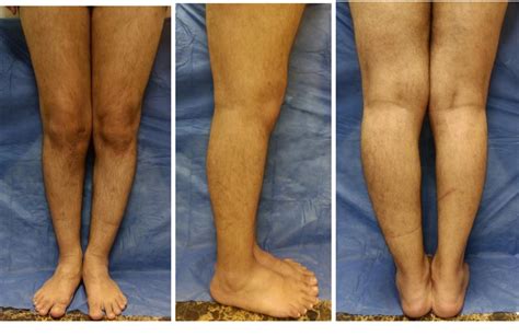 Figure 10 From Open Wedge High Tibial Osteotomy For Treatment Of Varus Knee Open Wedge High