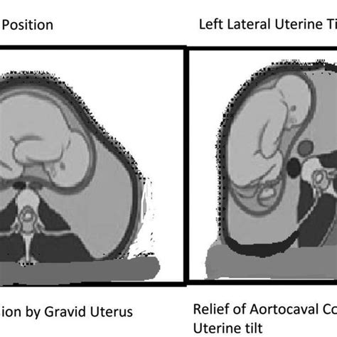Modifications For Resuscitation Of Cardiac Arrest In Pregnancy ACLS Download Scientific
