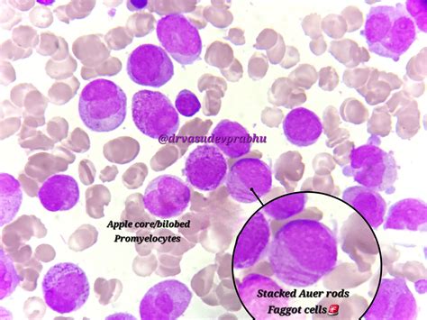 Pathology Outlines Apl With Pml Rara