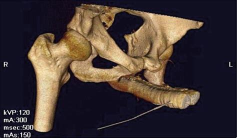 Erectile Dysfunction Caused By Cavernous Leakage Intechopen