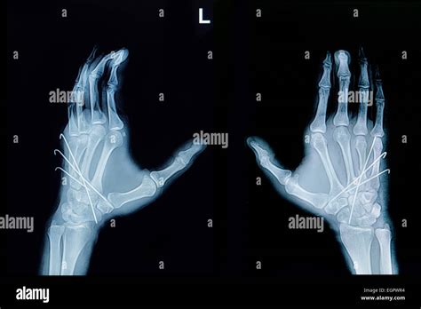 Film X Ray Of Hand Fracture Show Fracture Metacarpal Bone Insert With